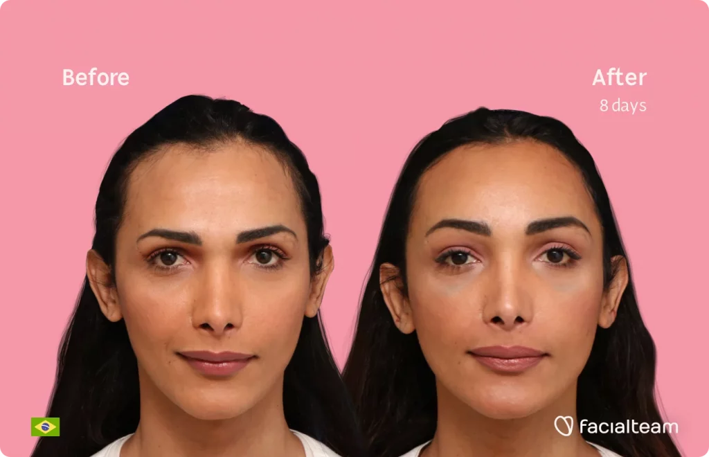 Let cia Before And After FFS Surgery Facialteam
