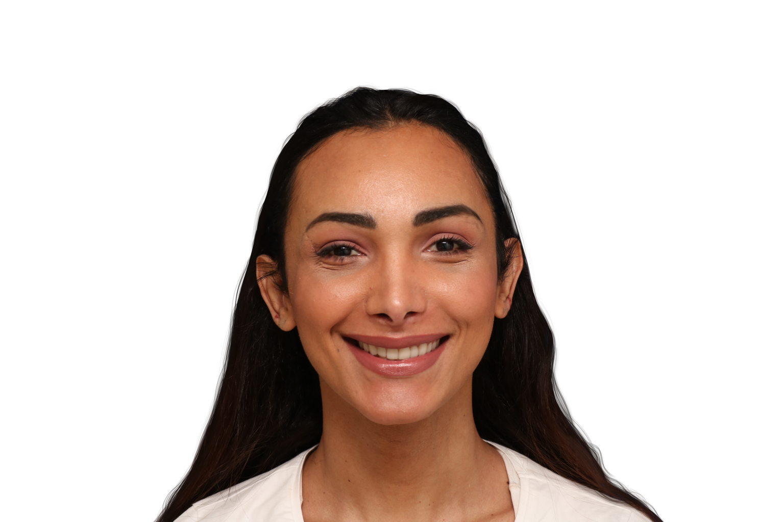 Letícia Before and After FFS Surgery — Facialteam