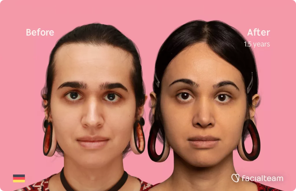 FFS In Germany Why Choose Facial Feminization Surgery In SpainFacialteam