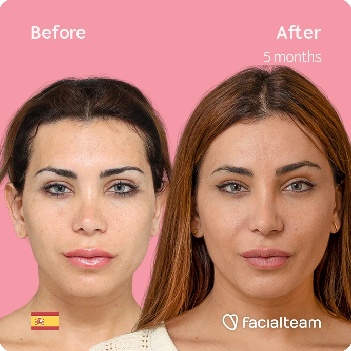 Isla Before and After FFS Surgery — Facialteam