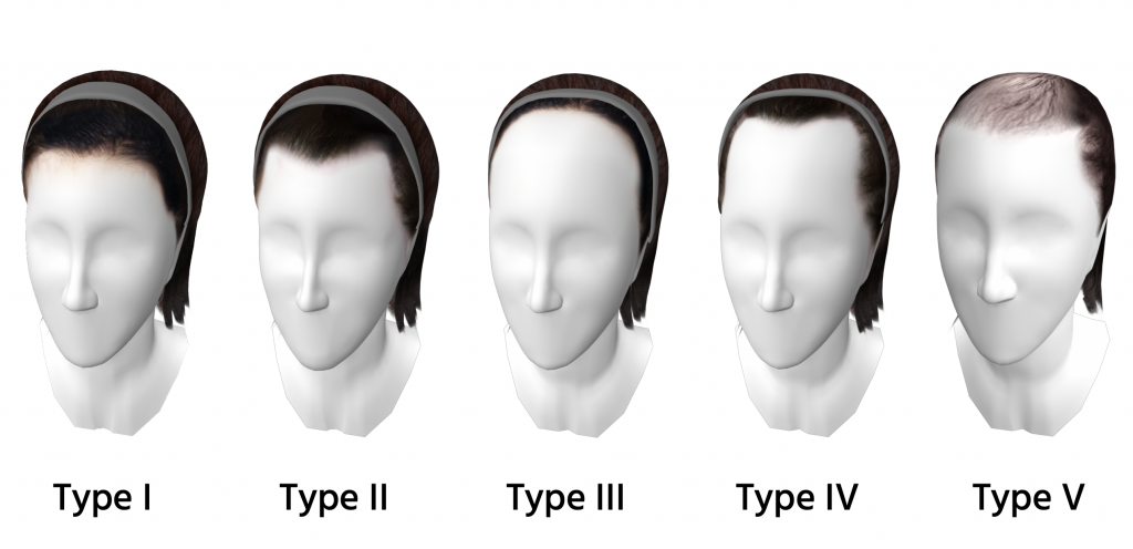 Options for a feminine hairline in facial gender surgery - FACIALTEAM